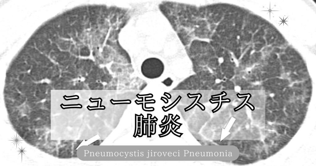 ニューモシスチス肺炎（PCP, Pneumocystis pneumonia） - 神戸きしだクリニック（神戸市中央区）