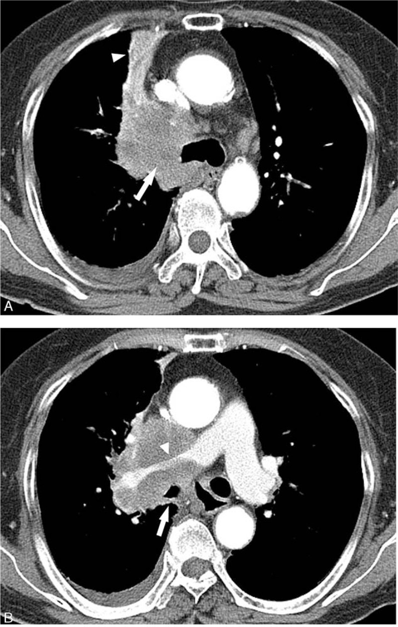 小細胞肺癌（SCLC. Small Cell Lung Cancer） – 呼吸器疾患 - 神戸きしだクリニック（神戸市中央区）