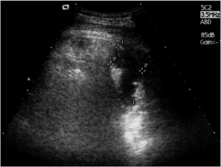 横隔膜下膿瘍(Subphrenic abscess) – 呼吸器疾患 - 神戸きしだクリニック（神戸市中央区）