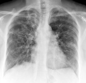 アレルギー性気管支肺アスペルギルス症（ABPA. Allergic bronchopulmonary aspergillosis） - 神戸 ...