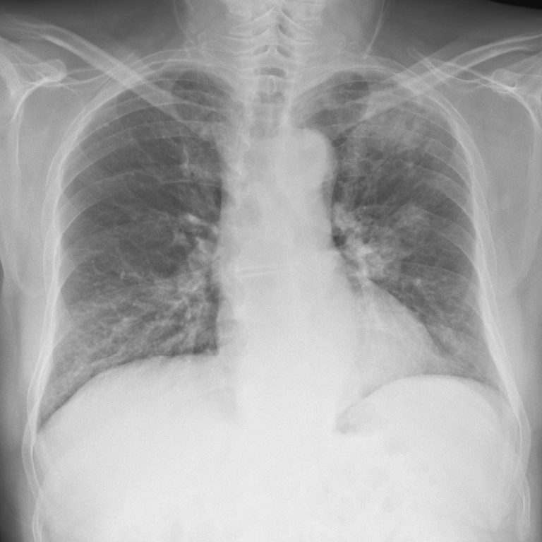 好酸球性多発血管炎性肉芽腫症（EGPA. Eosinophilic granulomatosis with polyangiitis） – 呼吸器疾患 - 神戸きしだクリニック（神戸市中央区）