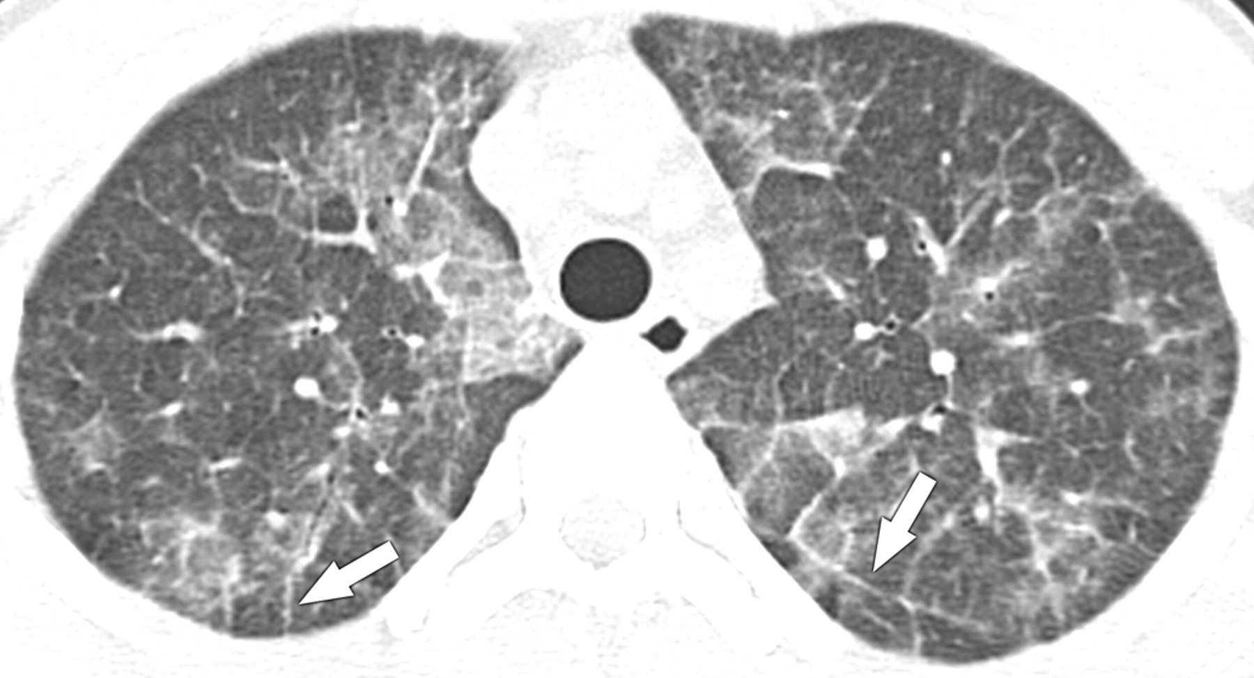 ニューモシスチス肺炎（PCP, Pneumocystis pneumonia） - 神戸きしだクリニック（神戸市中央区）