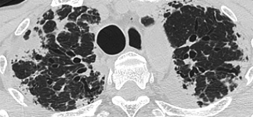 顕微鏡的多発血管炎（MPA. Microscopic polyangiitis） – 呼吸器疾患 - 神戸きしだクリニック（神戸市中央区）