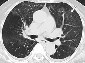 顕微鏡的多発血管炎（MPA. Microscopic polyangiitis） – 呼吸器疾患 - 神戸きしだクリニック（神戸市中央区）