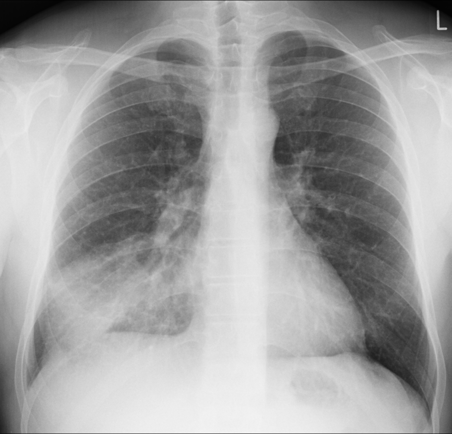 細菌性肺炎 (Bacterial pneumonia) - 神戸きしだクリニック（神戸市中央区）
