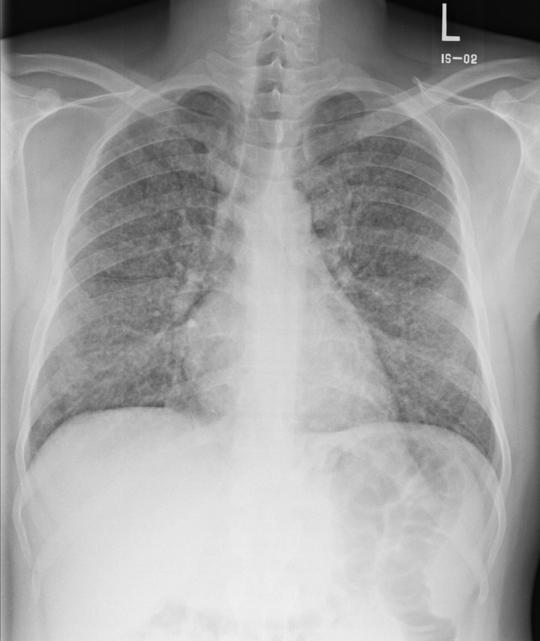 肺胞蛋白症(PAP.Pulmonary alveolar proteinosis) – 呼吸器疾患 - 神戸きしだクリニック（神戸市中央区）