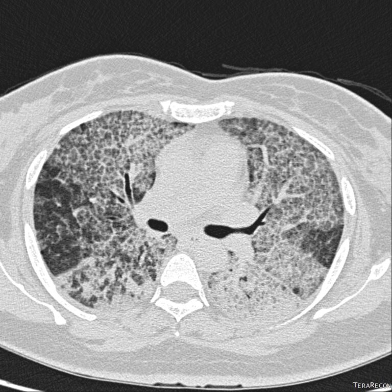 肺胞蛋白症(PAP.Pulmonary alveolar proteinosis) – 呼吸器疾患 - 神戸きしだクリニック（神戸市中央区）