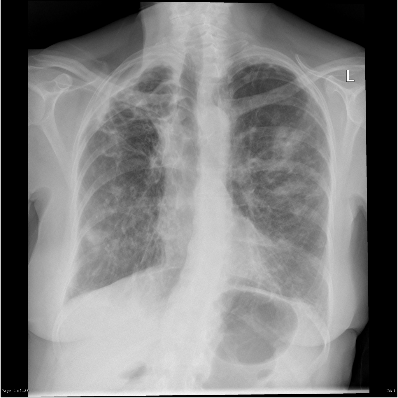 MAC症（MAC. Mycobacterium avium complex） – 呼吸器疾患 - 神戸きしだクリニック（神戸市中央区）