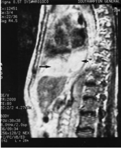 横隔膜下膿瘍(Subphrenic abscess) – 呼吸器疾患 - 神戸きしだクリニック（神戸市中央区）