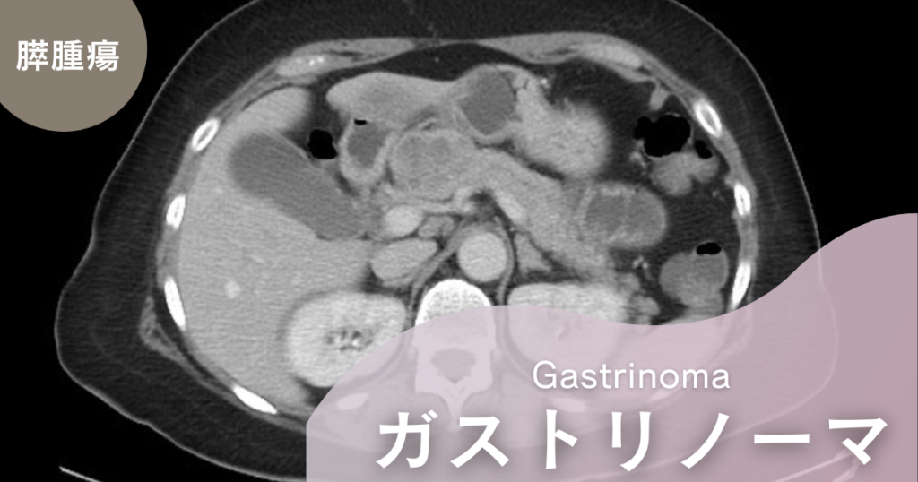 ガストリノーマ（Gastrinoma） – 内分泌疾患 - 神戸きしだクリニック（神戸市中央区）