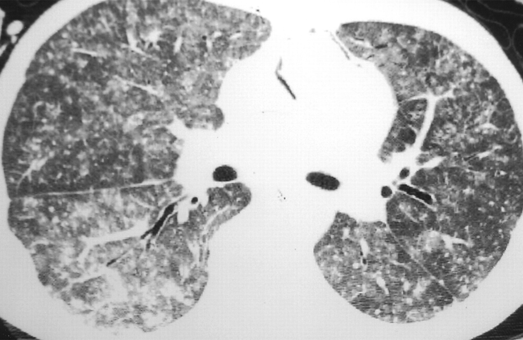 サイトメガロウイルス肺炎（CMV. Cytomegalovirus pneumonia） – 呼吸器疾患 - 神戸きしだクリニック（神戸市中央区）