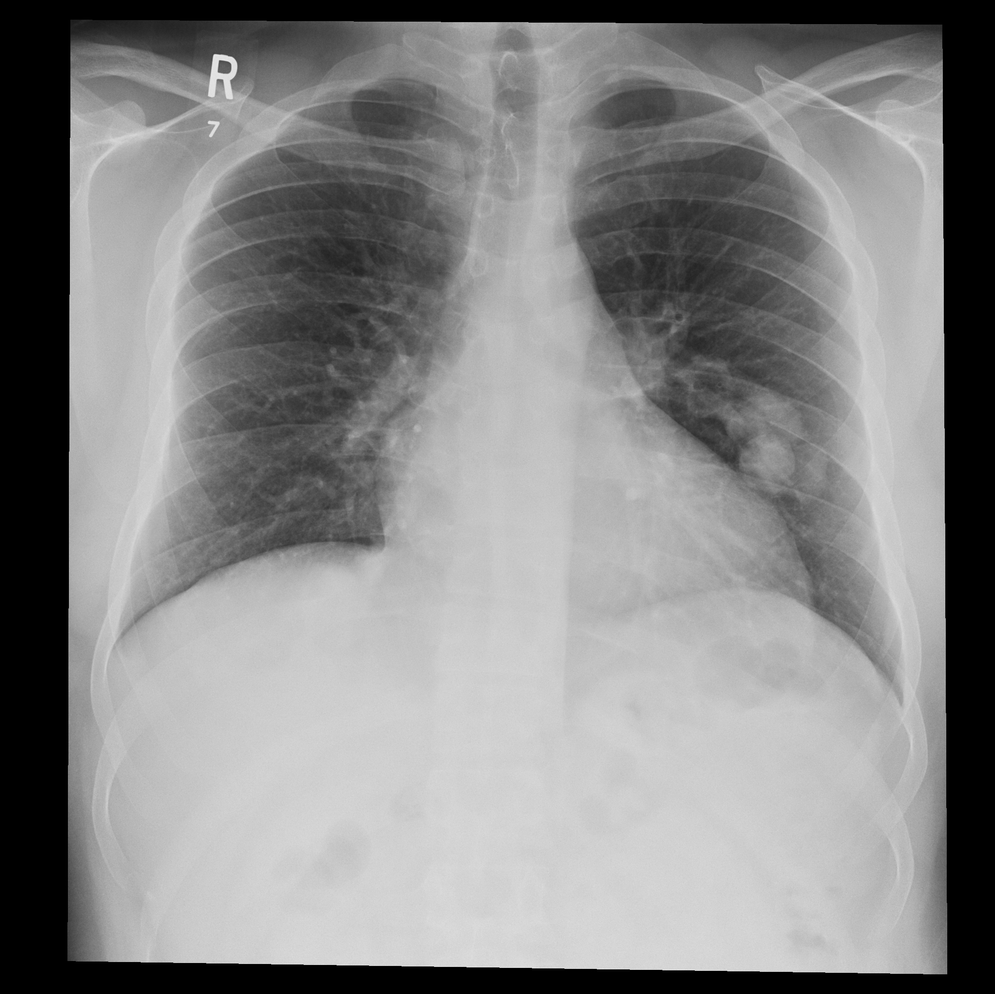 肺動静脈瘻・肺動静脈血管奇形（Pulmonary arteriovenous fistula / PAVM. Pulmonary ...