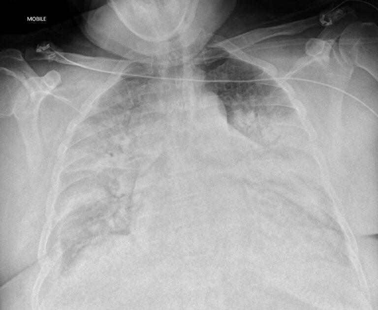 静水圧性肺水腫（HPE. Hydrostatic pulmonary edema） – 呼吸器疾患 - 神戸きしだクリニック（神戸市中央区）