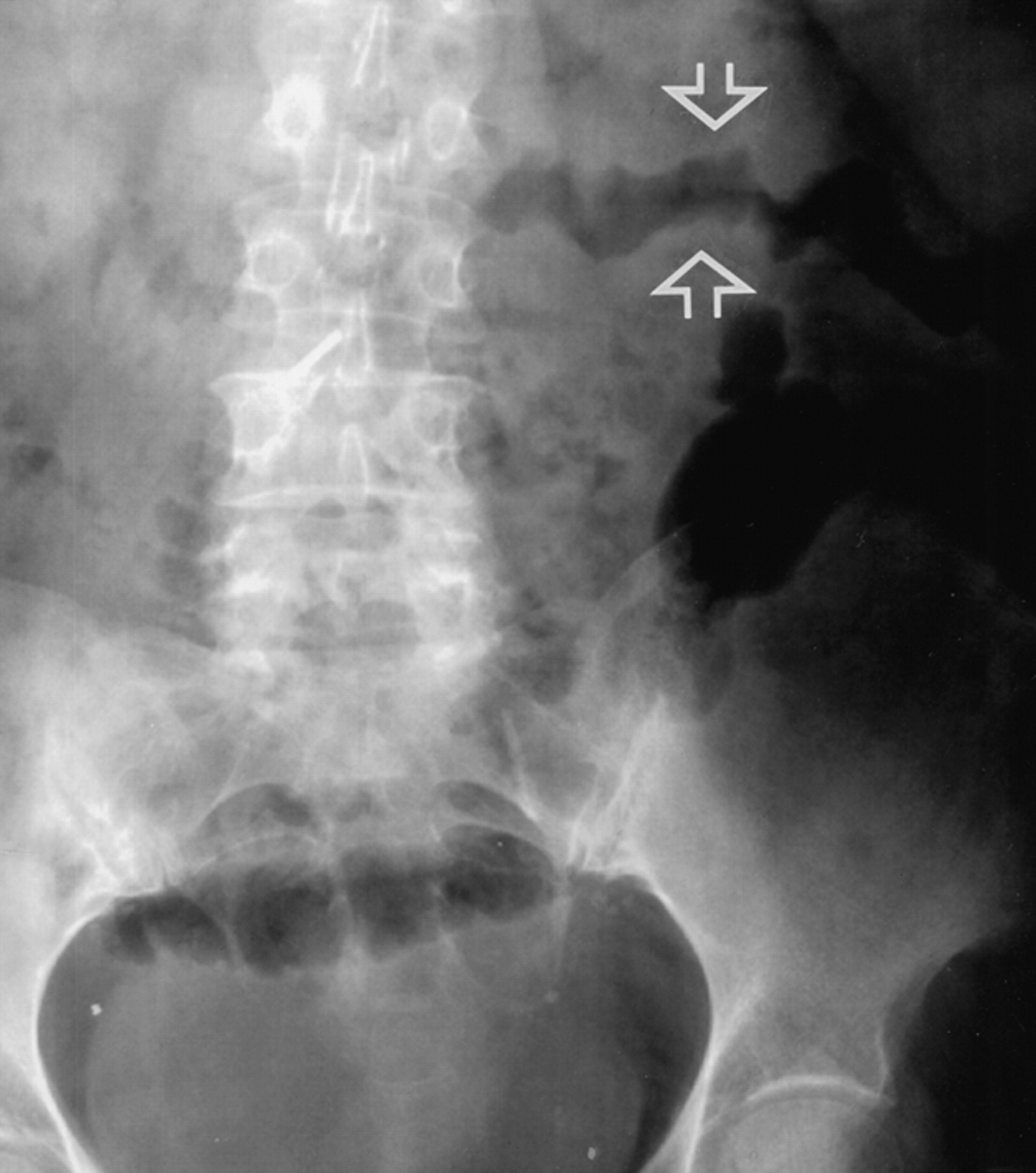出血性大腸炎（Hemorrhagic colitis） – 感染症 - 神戸きしだクリニック（神戸市中央区）