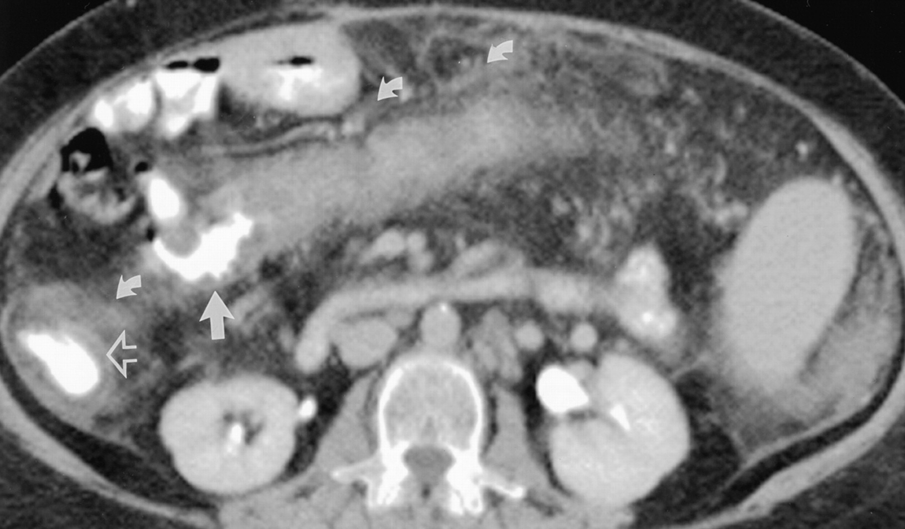 出血性大腸炎（Hemorrhagic colitis） – 感染症 - 神戸きしだクリニック（神戸市中央区）