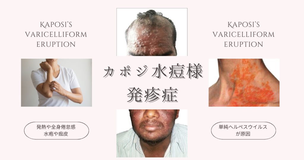 カポジ水痘様発疹症（Kaposi’s varicelliform eruption） – 感染症 - 神戸きしだクリニック（神戸市中央区）