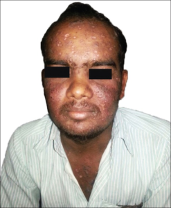 カポジ水痘様発疹症（Kaposi’s varicelliform eruption） – 感染症 - 神戸きしだクリニック（神戸市中央区）